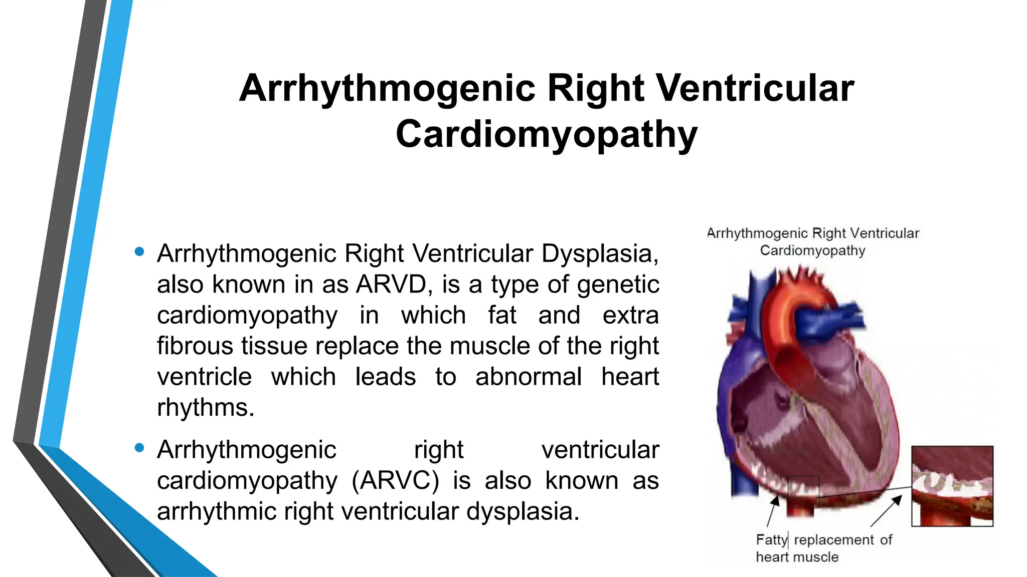 cardiomyopathies, types and nursing management.pptx