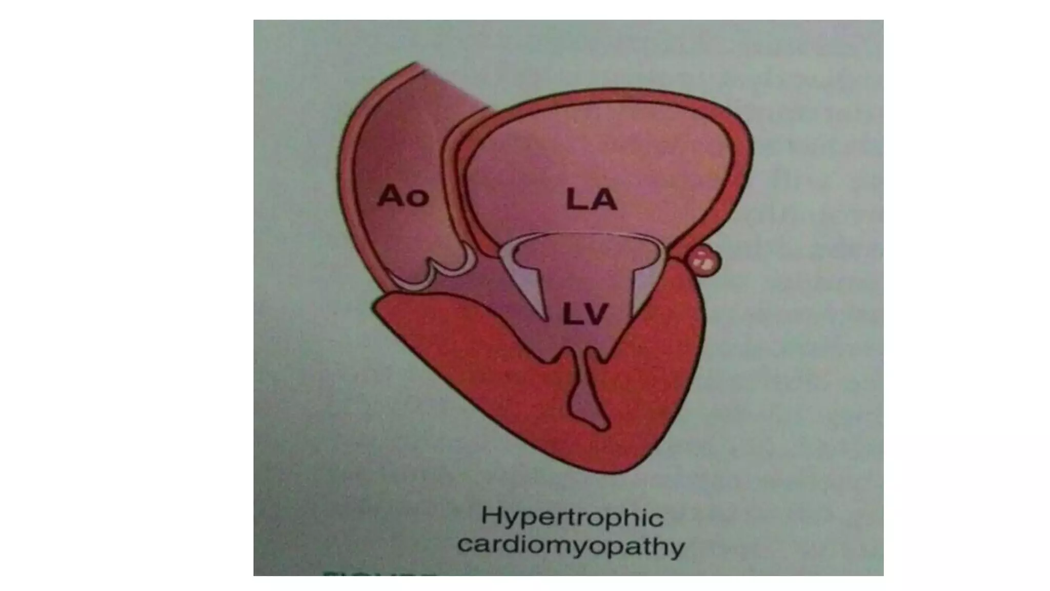Pathology of Cardiomyopathies | PPTX