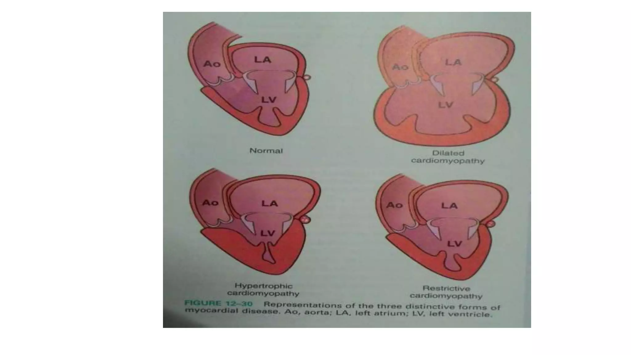 Pathology of Cardiomyopathies | PPTX