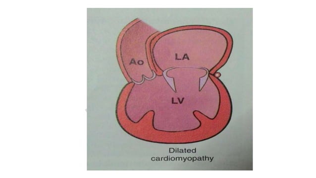 Pathology of Cardiomyopathies | PPTX