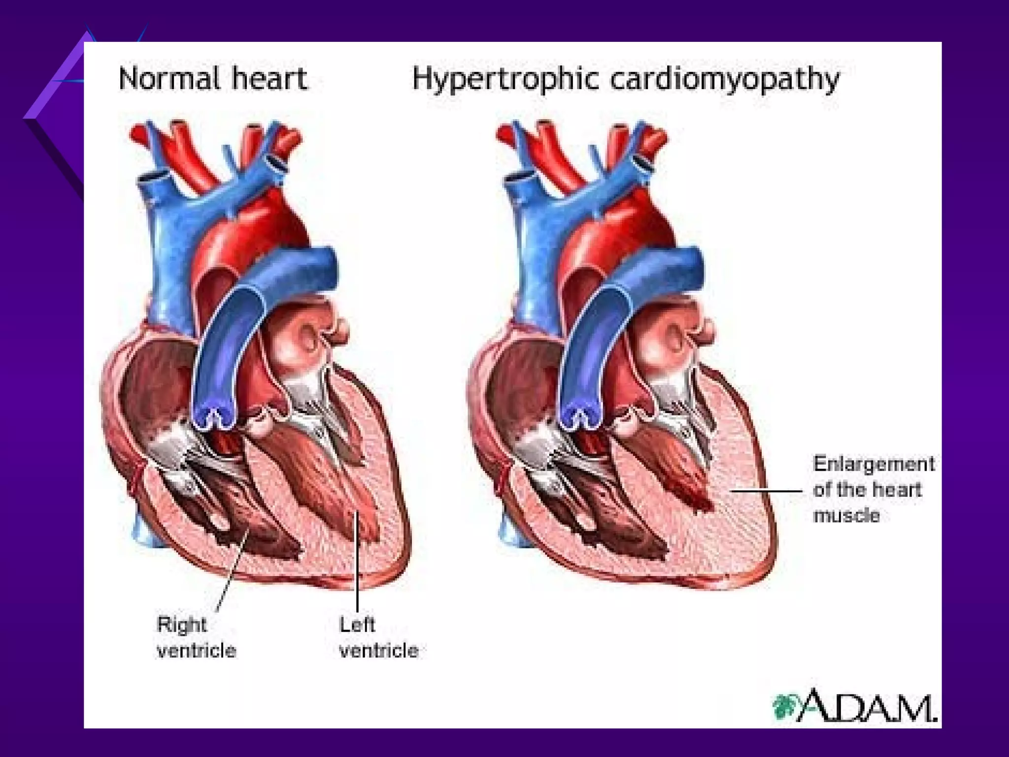 Cardiomyopathy | PPT