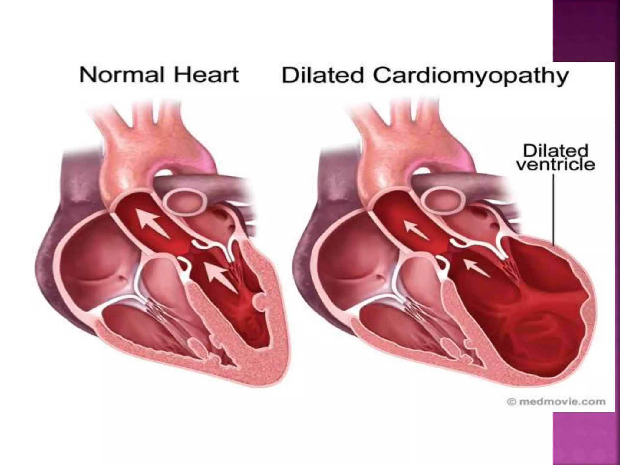 Cardiomyopathy | PPTX