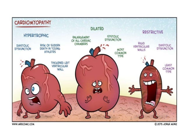 Cardiomyopathy