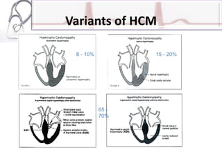 Cardiomyopathy | PDF