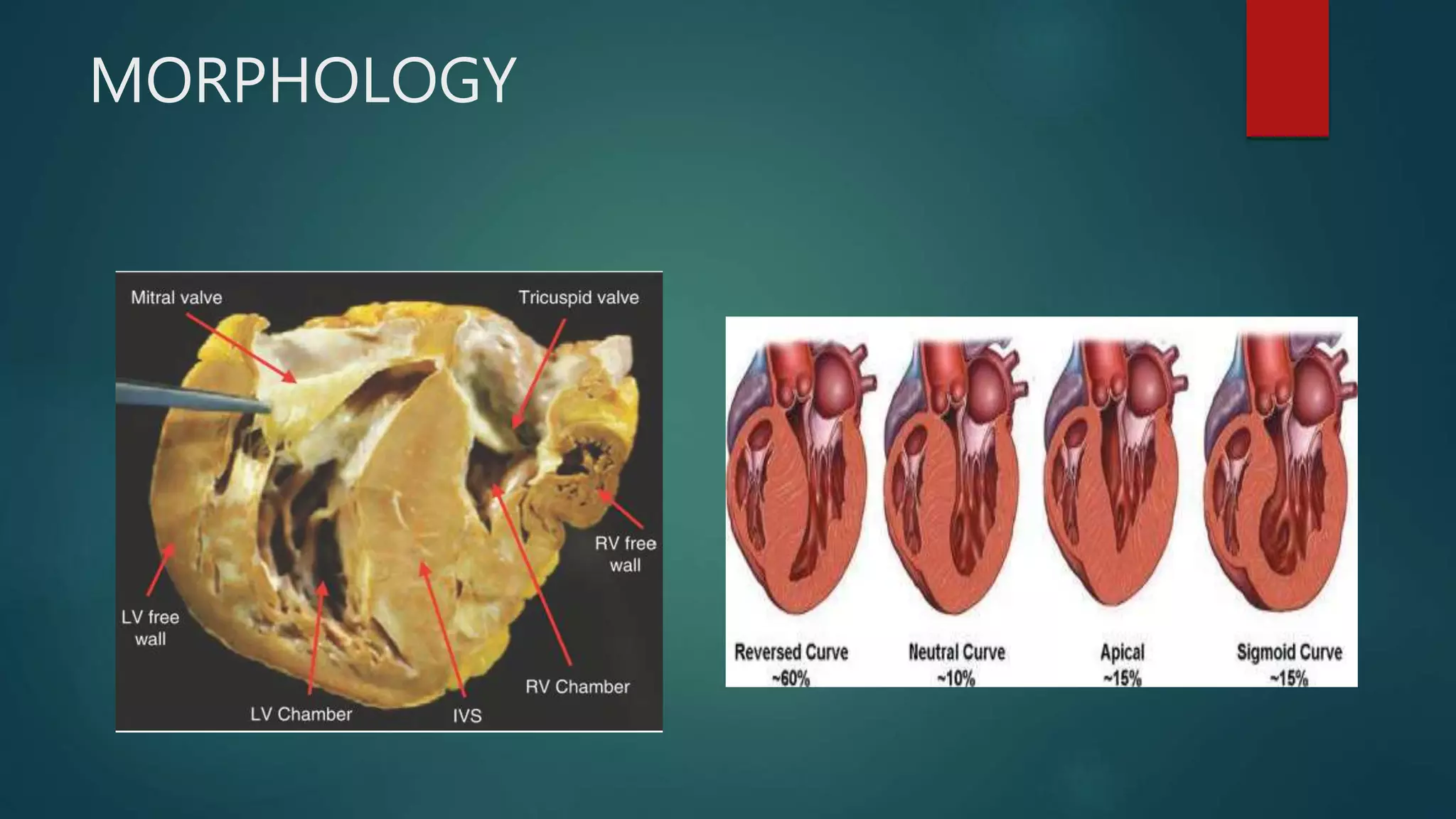 Cardiomyopathy | PPTX