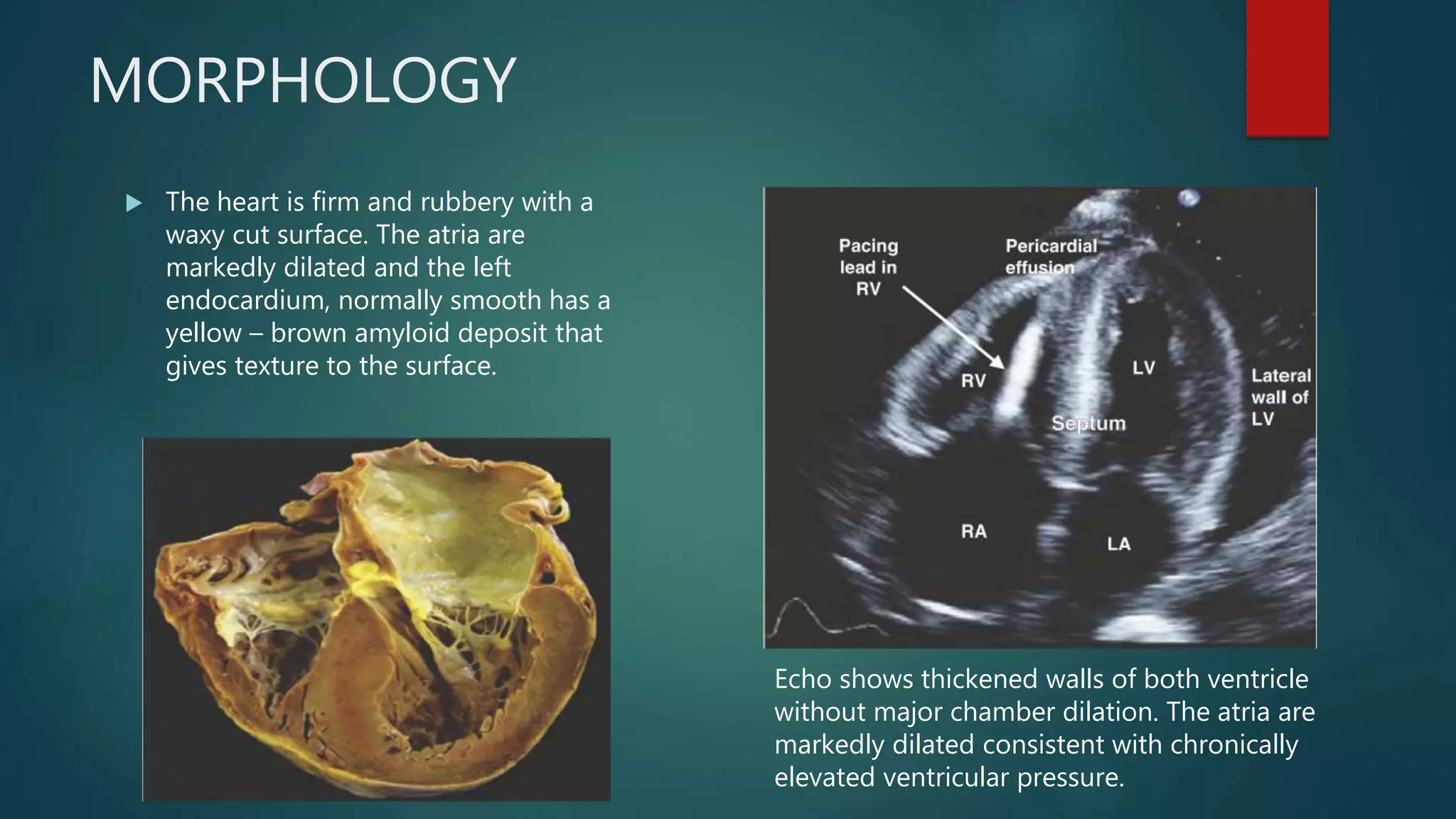 Cardiomyopathy | PPTX