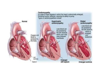 Cardiomyopathy | PPTX