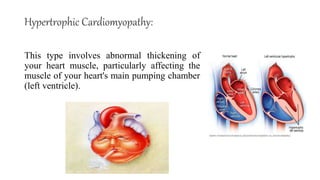 Cardiomyopathy | PPTX