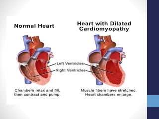 Cardiomyopathy | PPT