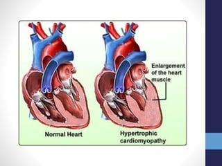Cardiomyopathy | PPTX