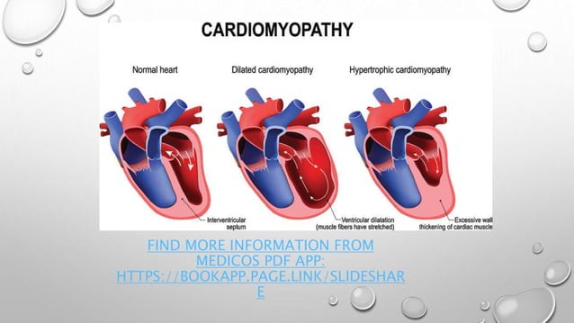 Cardiomyopathy | PPT