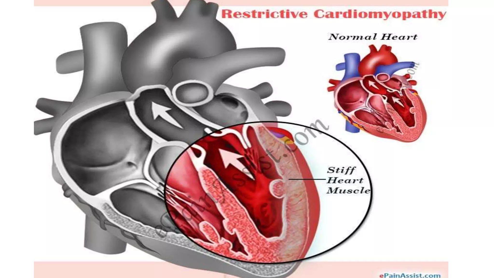 CARDIOMYOPATHY.pptx | Heart and Cardiovascular Diseases | Diseases and ...