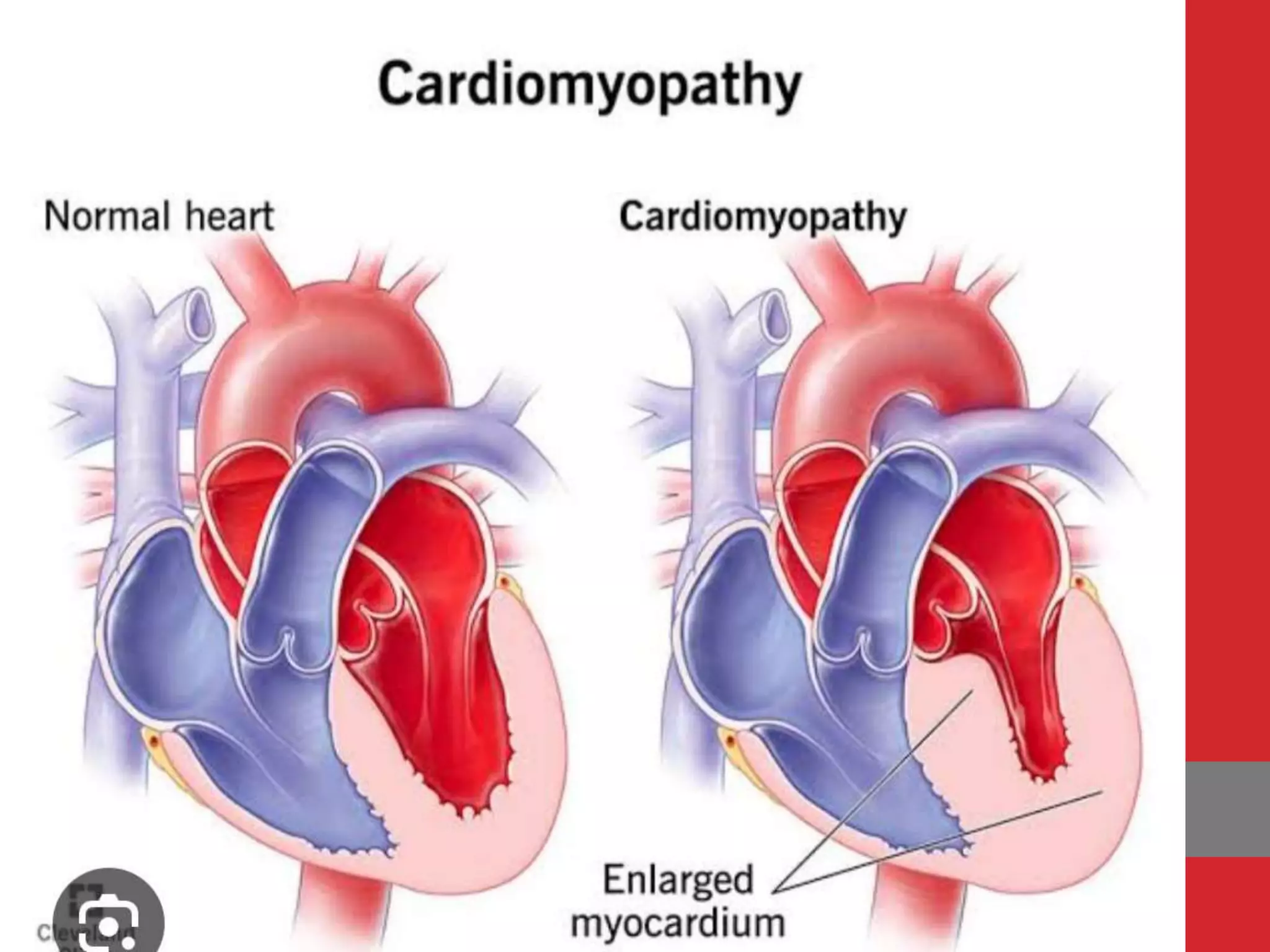 Cardiomyopathy.pptx