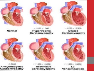Cardiomyopathy.pptx