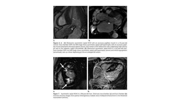 CARDIOMYOPATHY cardiac mri carduiac ct imaging | PPTX | Heart and ...