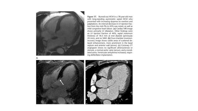 CARDIOMYOPATHY cardiac mri carduiac ct imaging | PPTX | Heart and ...
