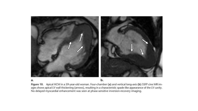 CARDIOMYOPATHY cardiac mri carduiac ct imaging | PPTX | Heart and ...