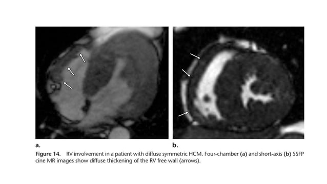 CARDIOMYOPATHY cardiac mri carduiac ct imaging | PPTX | Heart and ...
