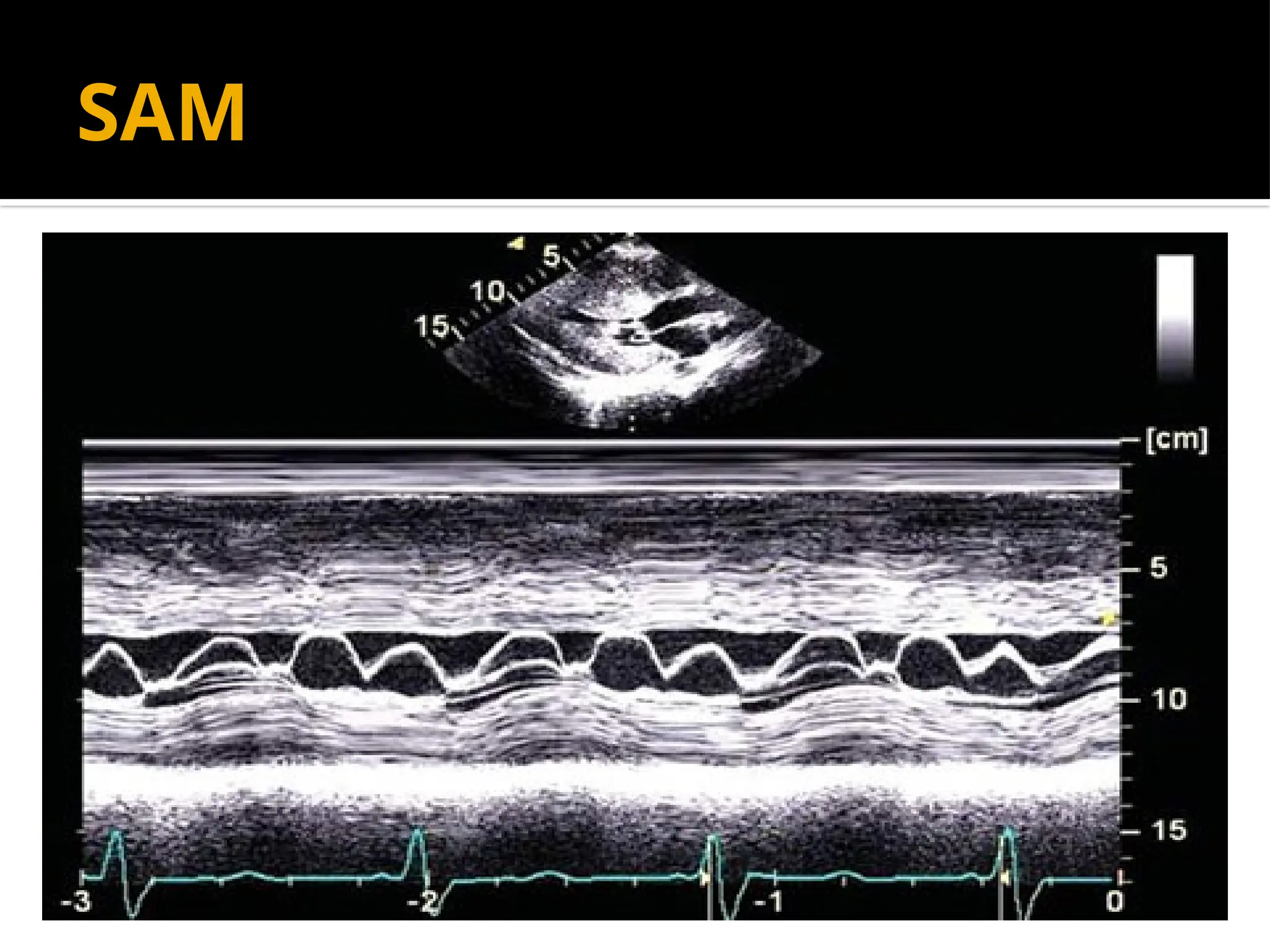 cardiomyopathy roshini Priya phd. .pptx