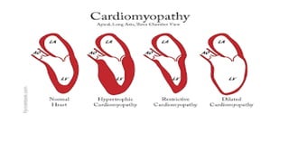Cardiomyopathy etiology,clinical picture.pptx