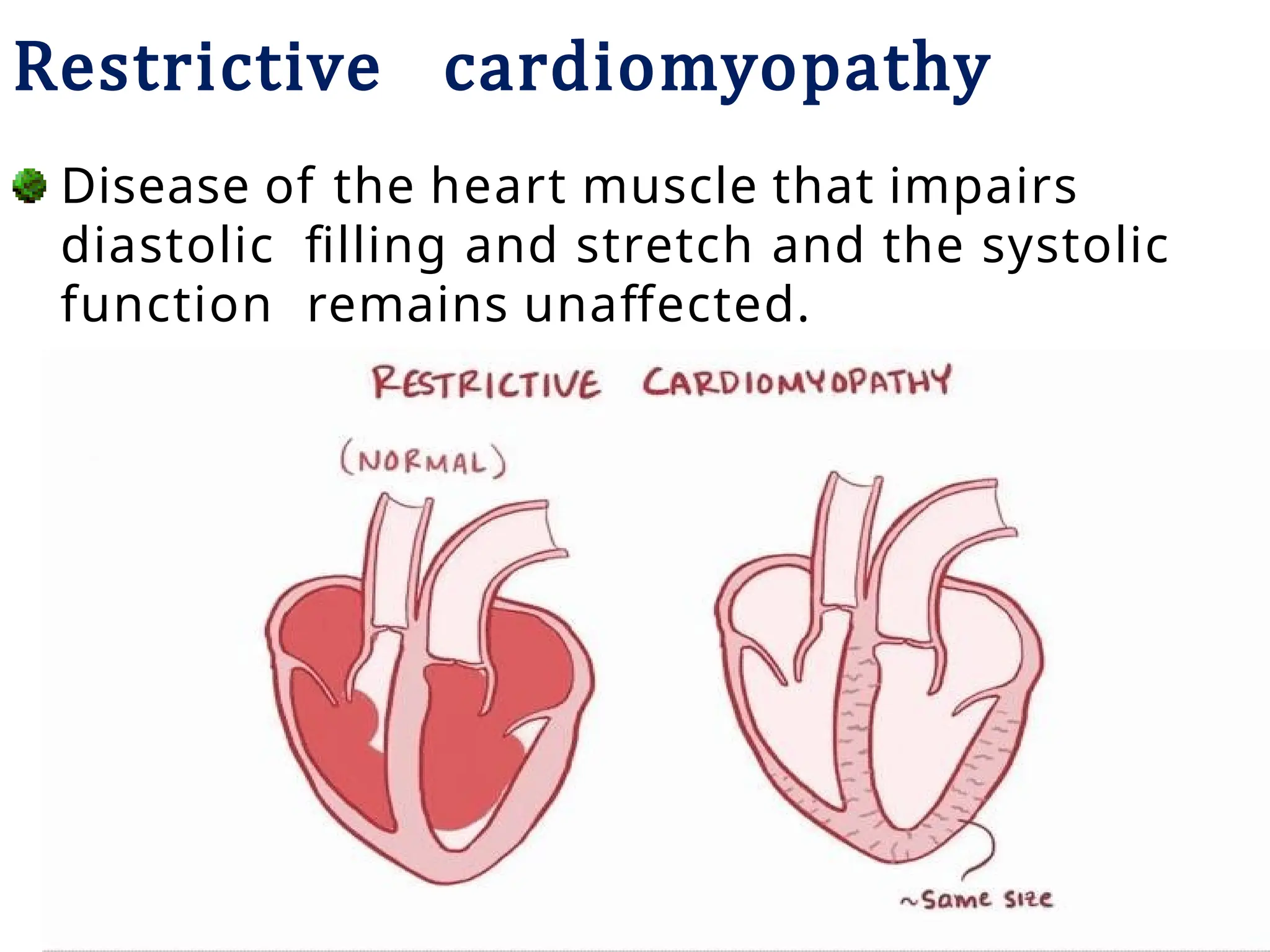 cardiomyopathy heart disease presentation | PPTX