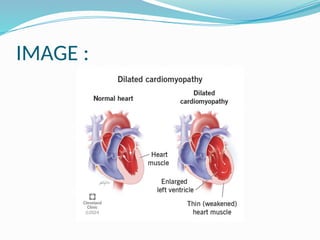 CARDIOMYOPATHY - DILATED CARDIOMYOPATHY.pptx