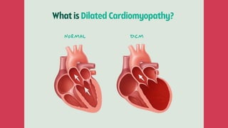 Comprehensive Overview of Cardiomyopathy: Causes, Types, Diagnostics ...