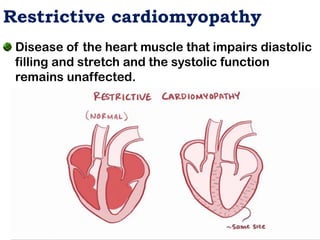 Cardiomyopathy | PDF
