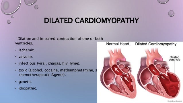 Cardiomyopathy