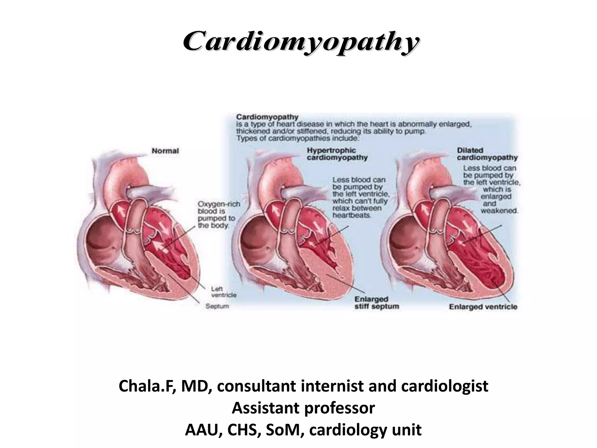 Cardiomyopathy - lecture.ppt