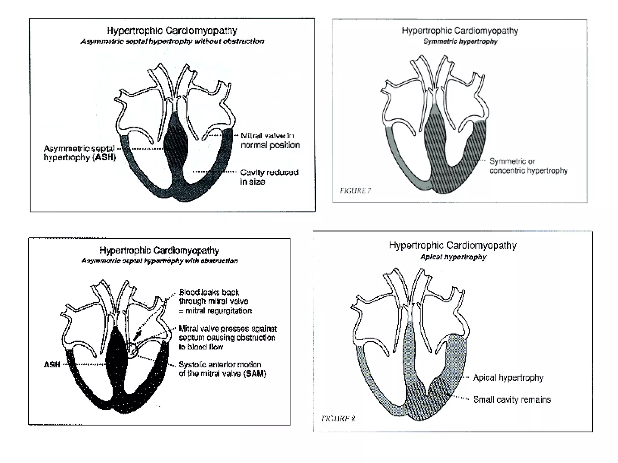 Cardiomyopathy - lecture.ppt
