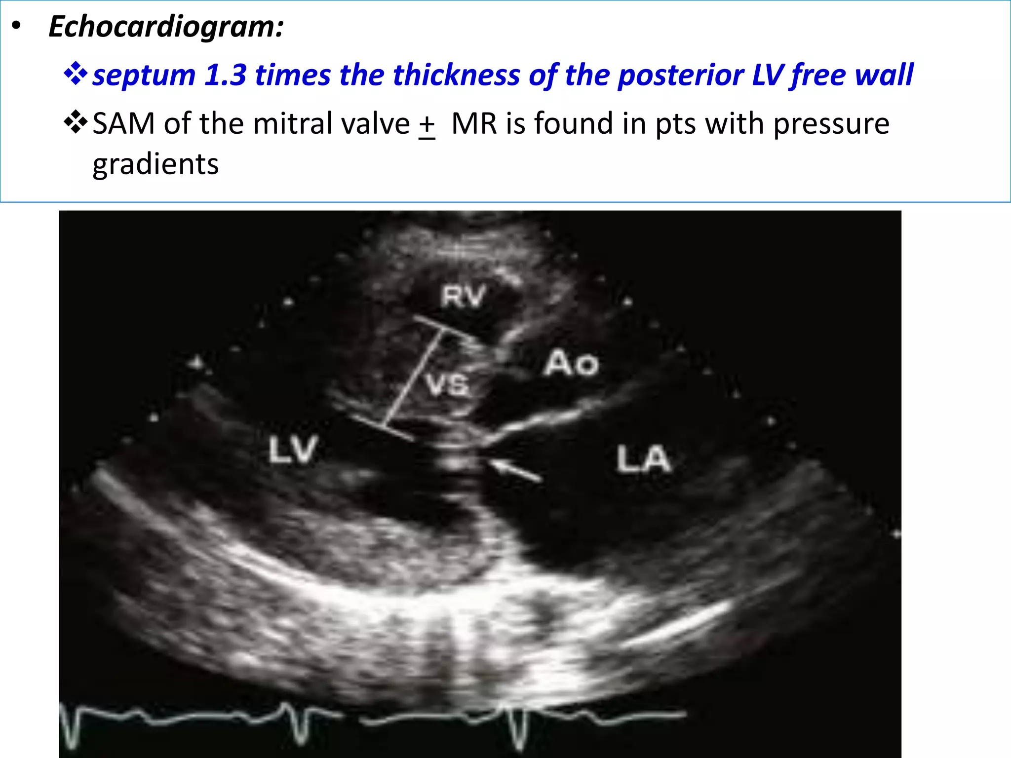 Cardiomyopathy - lecture.ppt