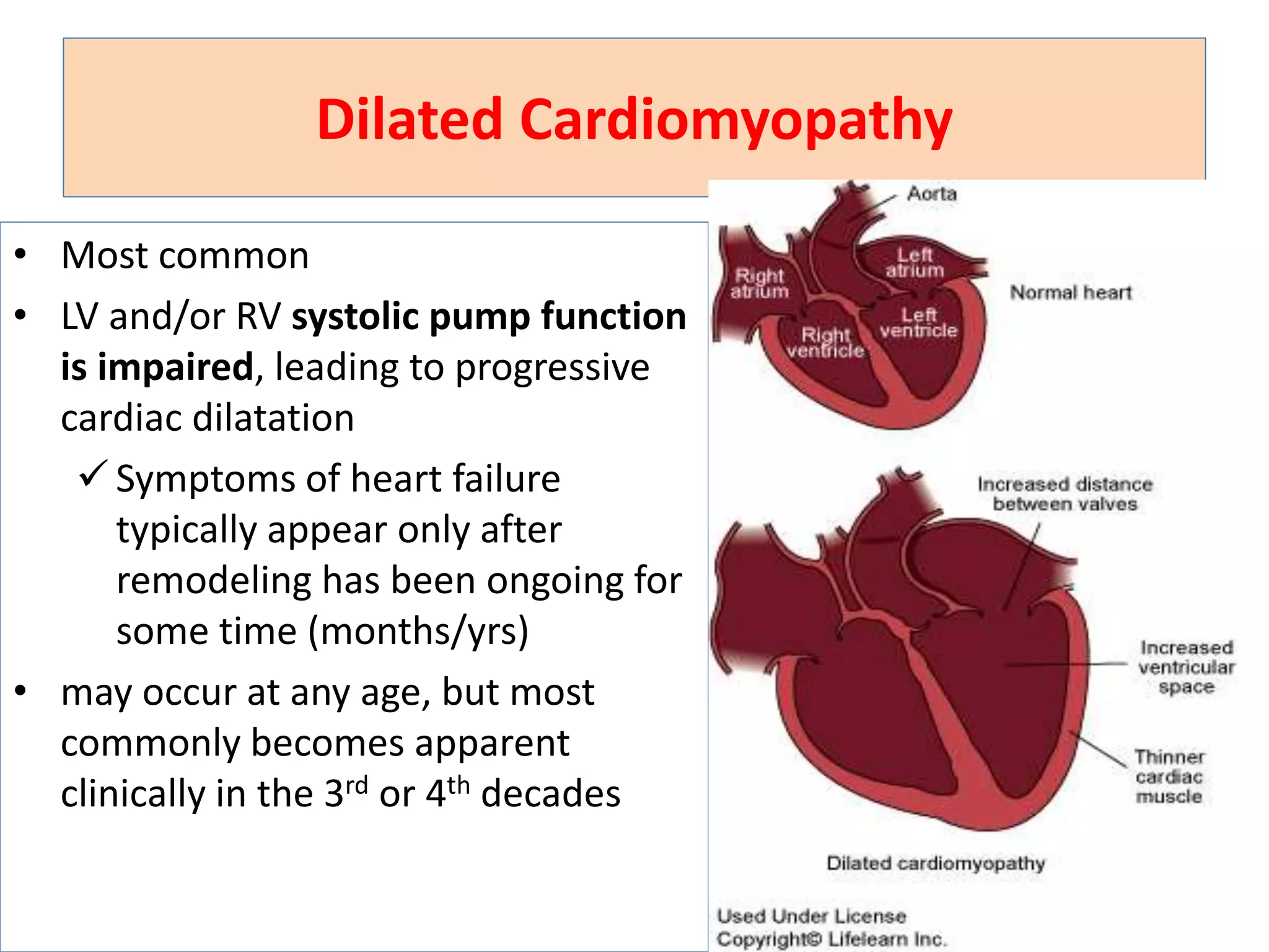 Cardiomyopathy - lecture.ppt