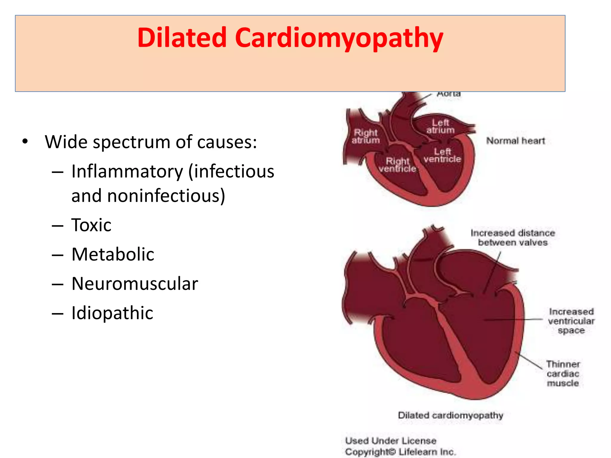 Cardiomyopathy - lecture.ppt