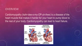 Cardiomyopathy | PPTX