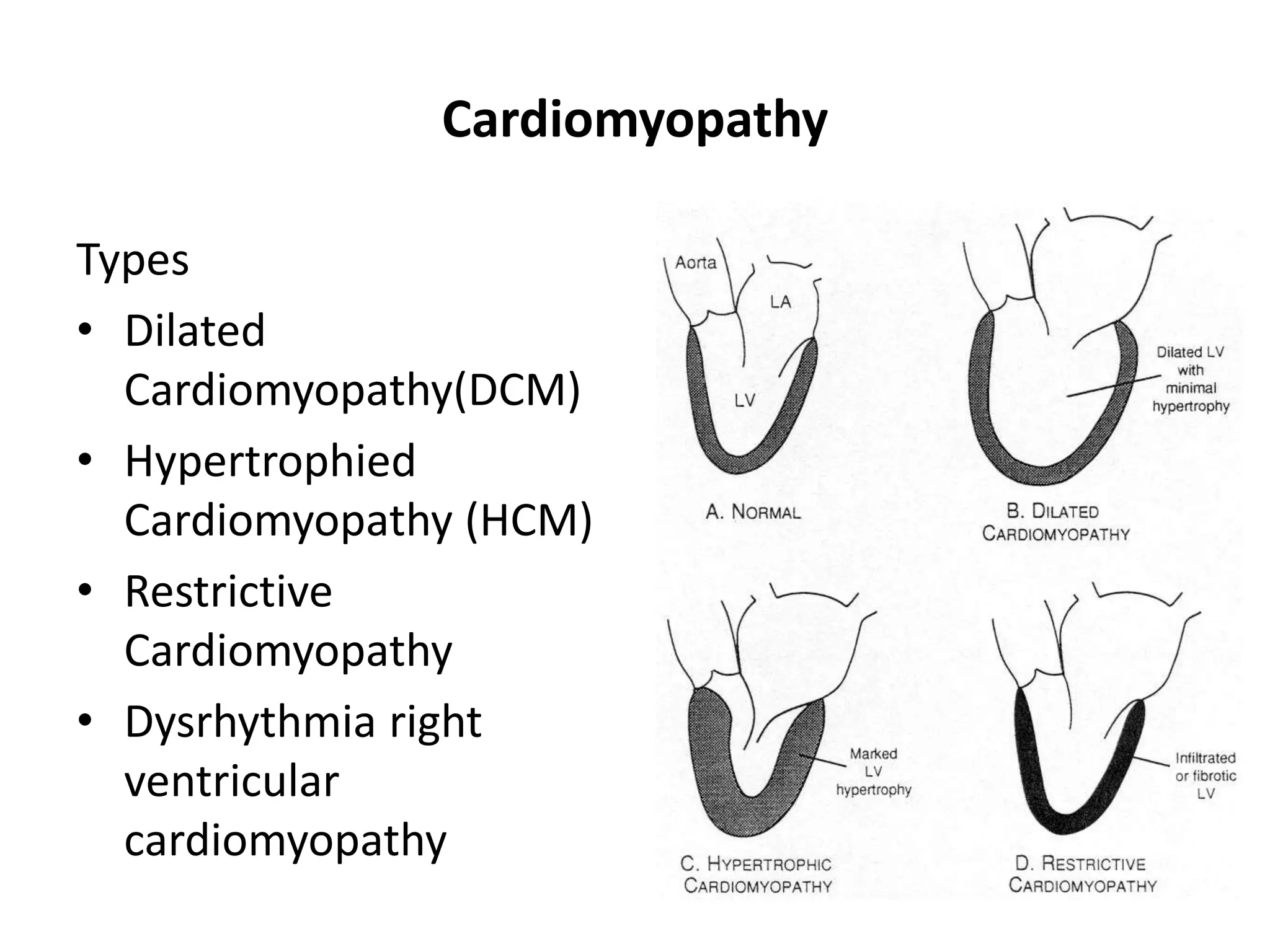Cardiomyopathy, Myocarditis and Pericarditis_C I lecture_Oct.ppt