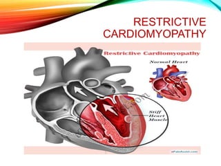 Cardiomyopathy | PPTX