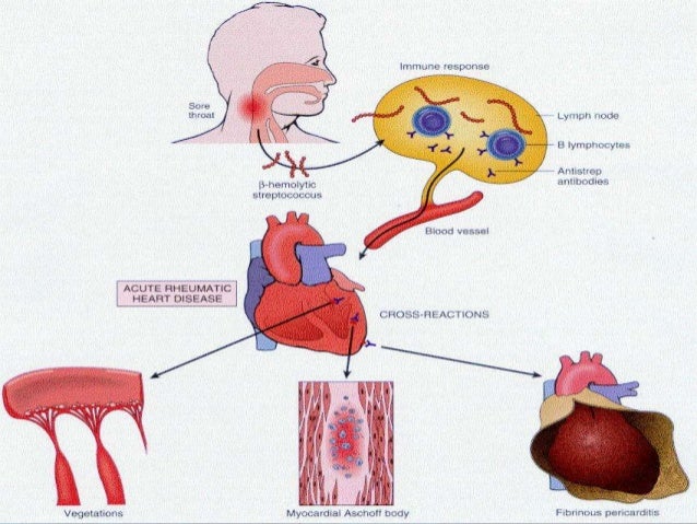 Cardiopatía reumática