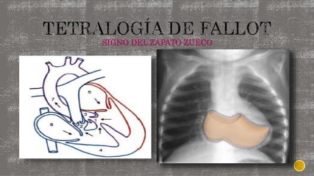 Cardiopatías congenitas. Signos clásicos radiológicos