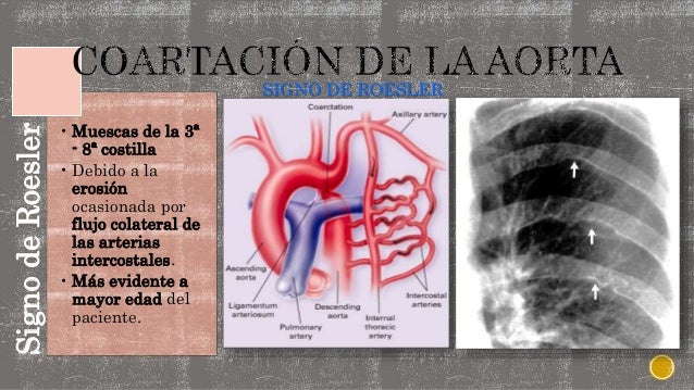 Cardiopatías congenitas. Signos clásicos radiológicos