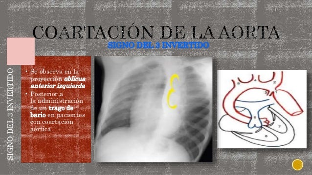 Cardiopatías congenitas. Signos clásicos radiológicos