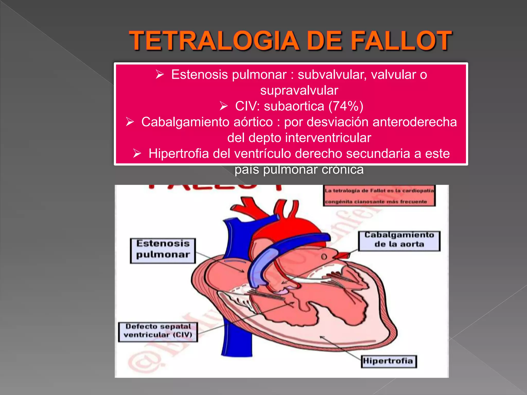 Cardiopatia cianogena. Tetralogia de fallot y Atresia tricuspidea.pptx