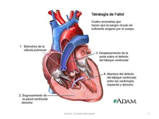 Cardiopatías Congénitas Cianóicas Ppt