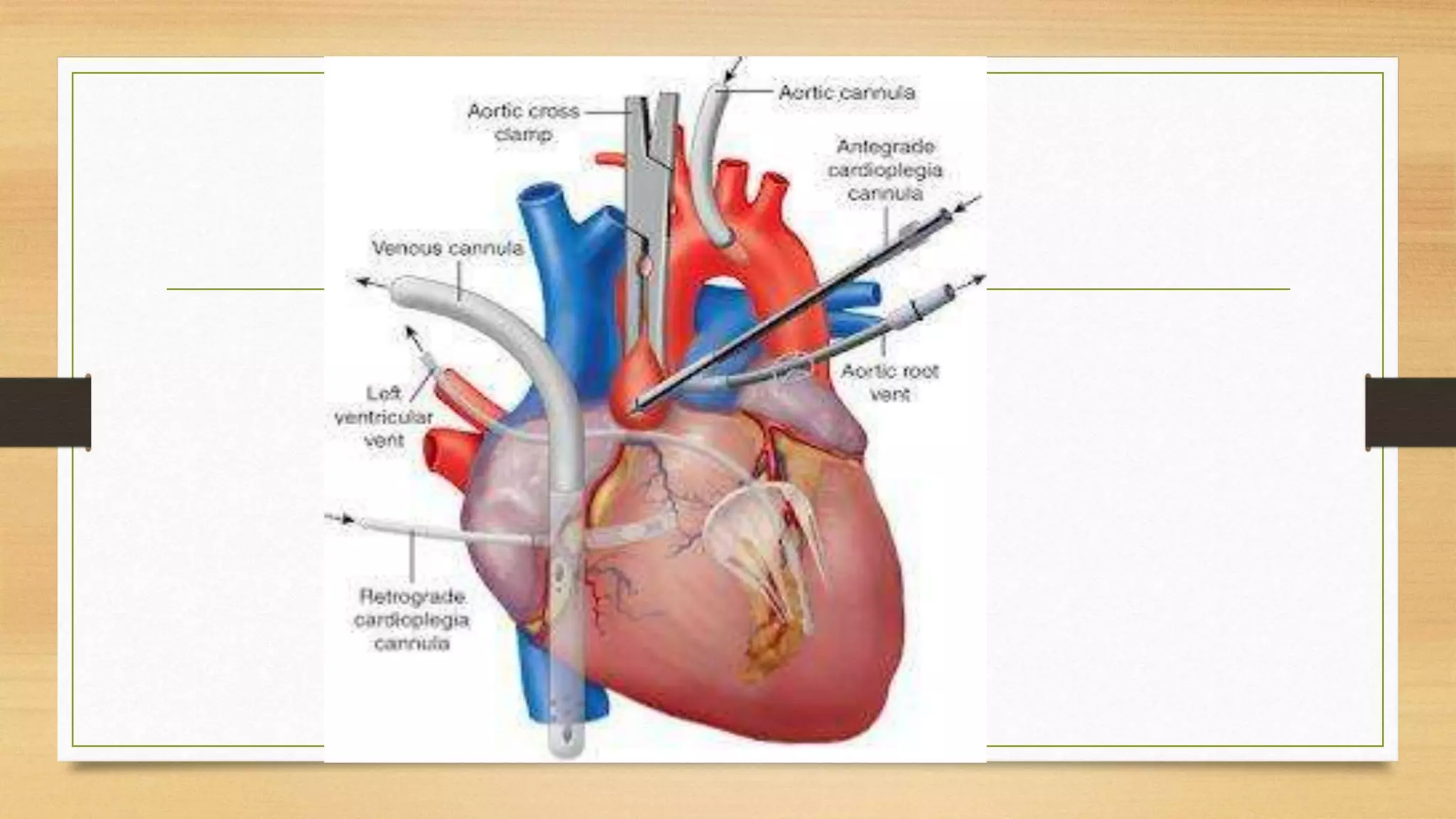 Cardioplegia Cannula.pptx