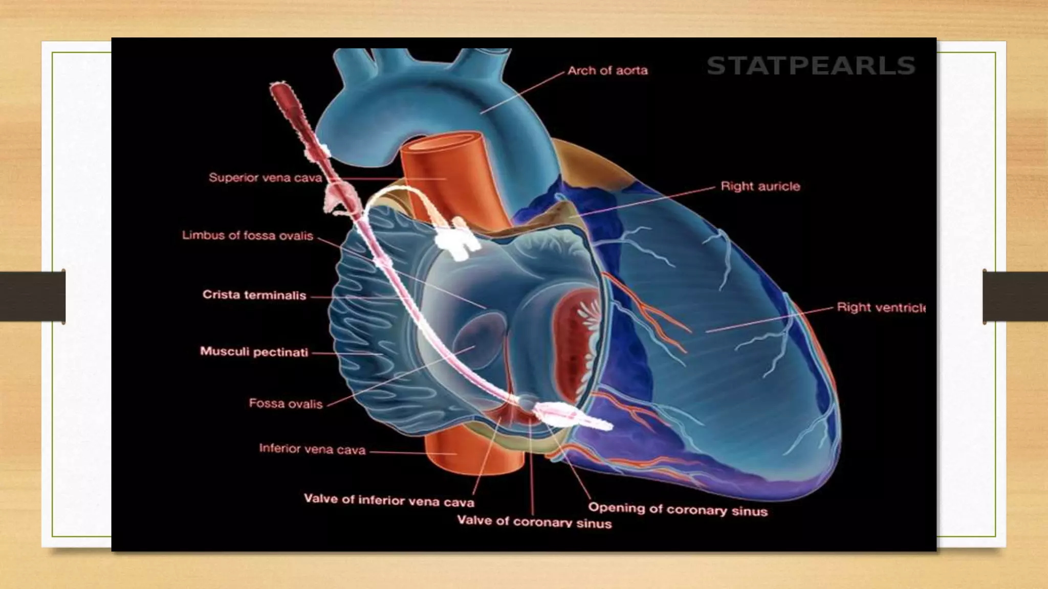 Cardioplegia Cannula.pptx