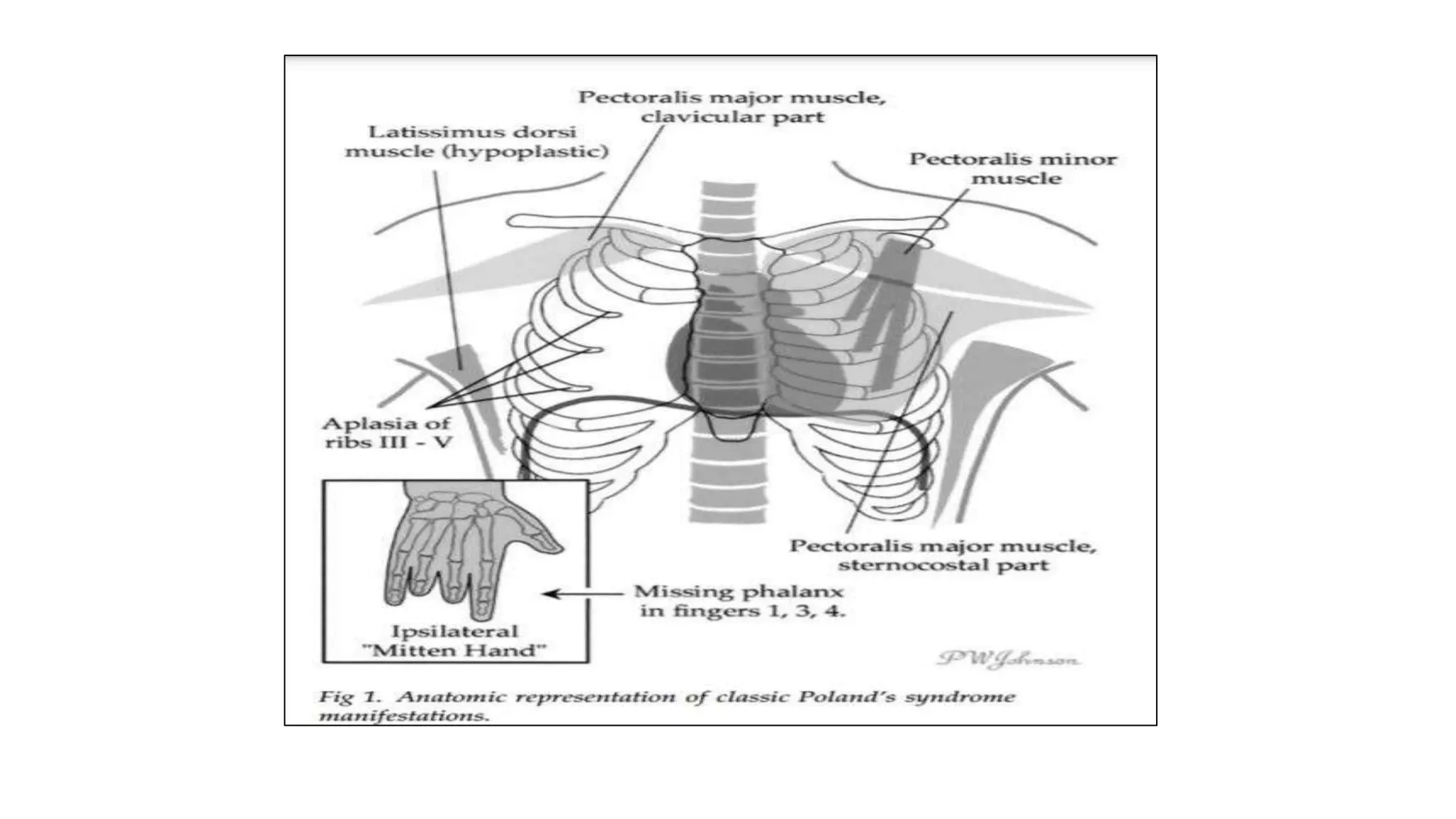 CHEST WALL DEFORMITY | PPTX | Lung and Respiratory Health | Diseases ...