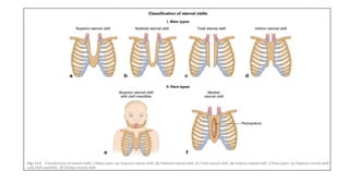 CHEST WALL DEFORMITY | PPTX | Lung and Respiratory Health | Diseases ...