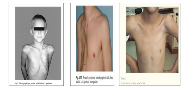 CHEST WALL DEFORMITY