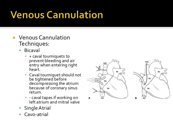 Cardiopulmonary bypass