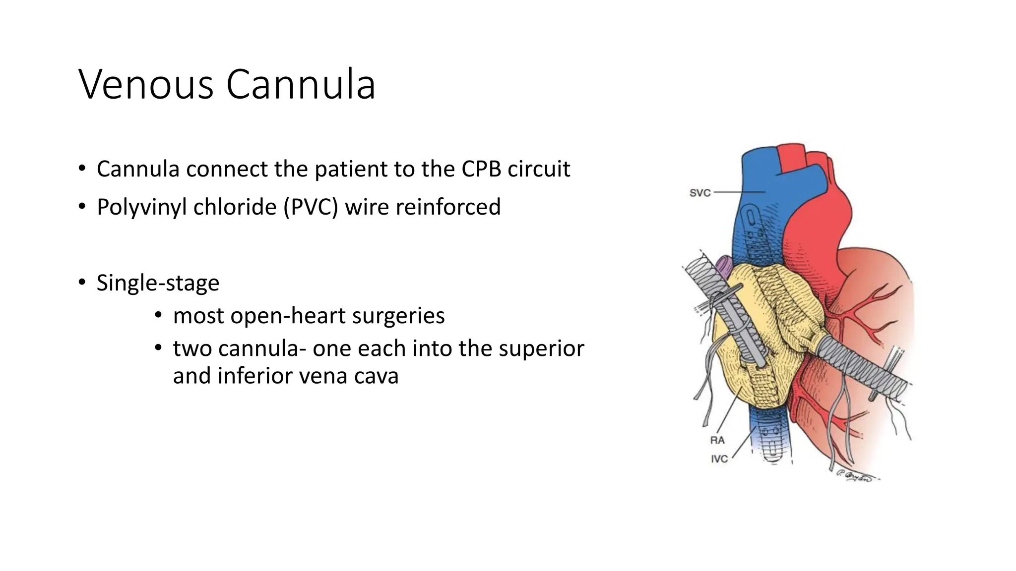 Cardiopulmonary bypass: Basic circuit, anticoagulation, blood ...